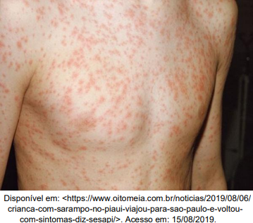 FPP 2019 O sarampo é uma doença grave e altamente contagiosa ...